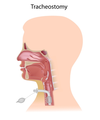 What You Should Know about Tracheostomy Care